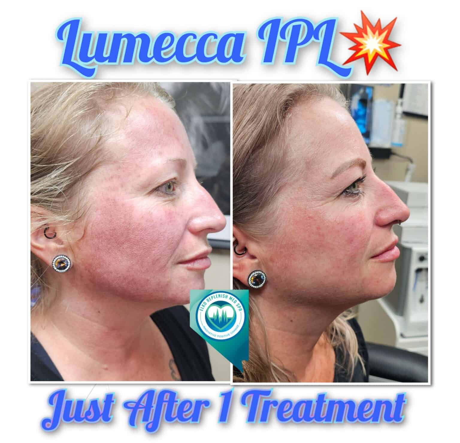 Before and Afters Photos | Elko Replenish Med Spa